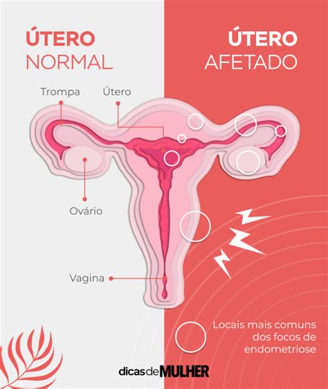Endometriose o que é causas sintomas e tratamentos