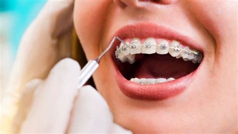 Braquete Soltou Saiba O Que Fazer E Quanto Custa Clinica OralDents