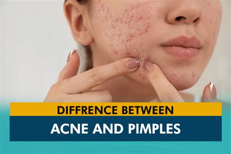 What Is The Difference Between Pimples Acne SkinQure