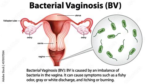 Bacterial Vaginosis Bv Infographic With Explanation Stock Vector