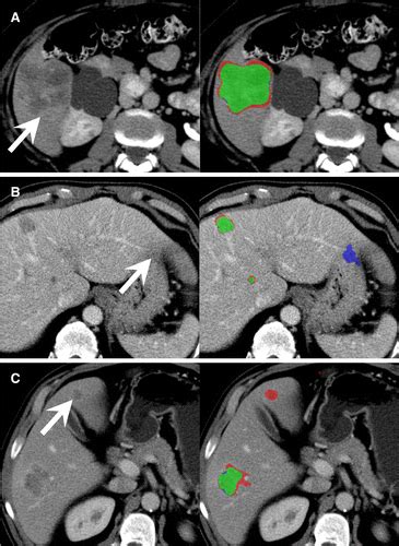 deep learning for automated segmentation of liver lesions at ct in patients with colorectal