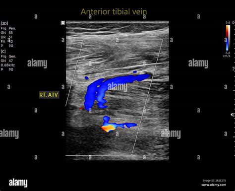 Détermination par échographie Doppler couleur chez les patients