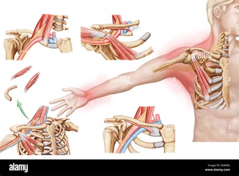 Medizinische Illustration Detaillierung Thoracic Outlet Syndrom