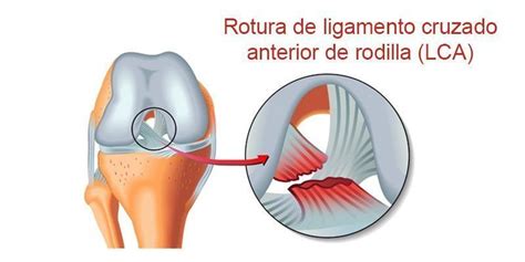 Rotura De Ligamento Cruzado Anterior O Lca Tratamiento