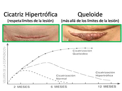 Diferença Entre Queloide E Cicatriz Hipertrofica BRAINCP