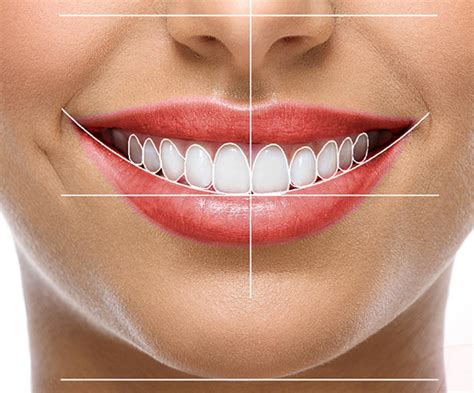 Tipos de Diseño de Sonrisa Clínica dental en Guatemala