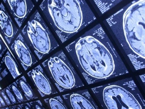 medical image segmentation using deep learning intel devmesh
