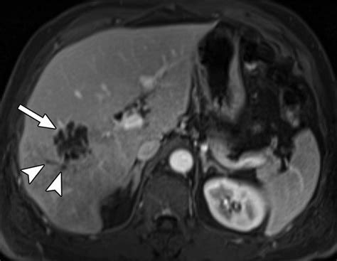 Cystic Lesions Of The Liver Ajr