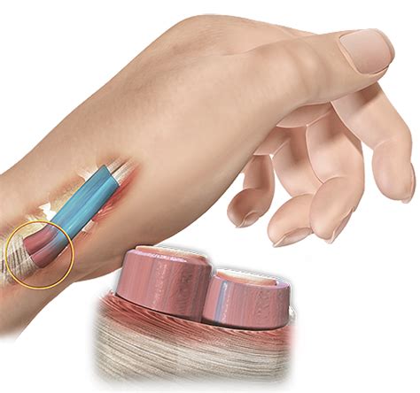 De Quervain S Tendinosis Memphis Orthopaedic Surgery Memphis Tennessee