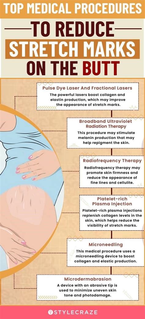 Stretch Marks On The Butt Causes And How To Get Rid Of Them