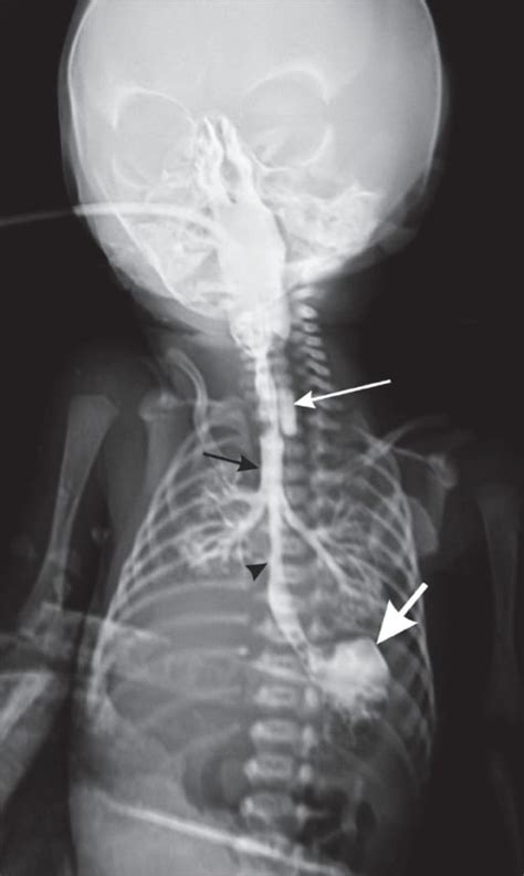 Esophageal Atresia And Tracheoesophageal Fistula Prenatal Sonographic