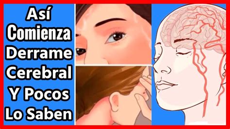 Qué Es Un Derrame Cerebral Atento Causas Y Consecuencias