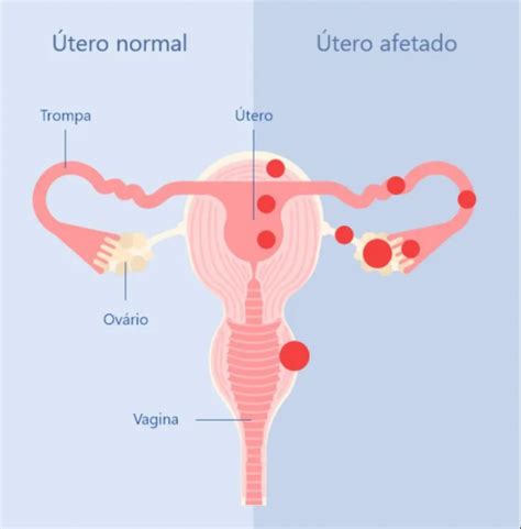 Endometriose Veja Os Principais Sintomas E Tratamento