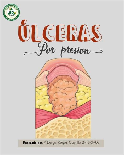 Úlceras por Presión Alberys Reyes Castillo uDocz