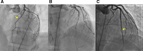 Spontaneous Coronary Artery Dissection Circulation Cardiovascular
