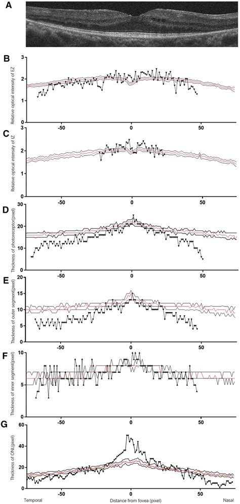 The Thickness And Optical Intensity Analysis Of Outer Retina In An RP