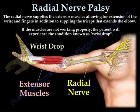 VASTRAL PHYSIOTHERAPY CLINIC Radial Nerve Palsy And Physiotherapy