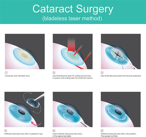 Steps Of Cataract Surgery Pdf
