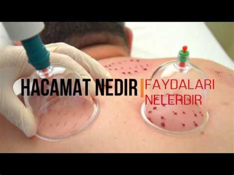 Hacamat nasıl yapılır Hacamat tedavisi ve faydaları YouTube