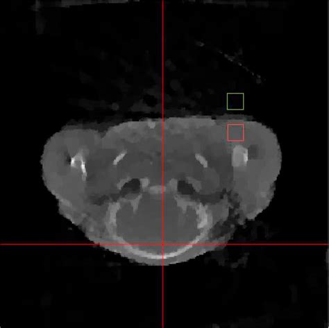 resolution and noise performance of sparse view x ray ct reconstruction via lp norm
