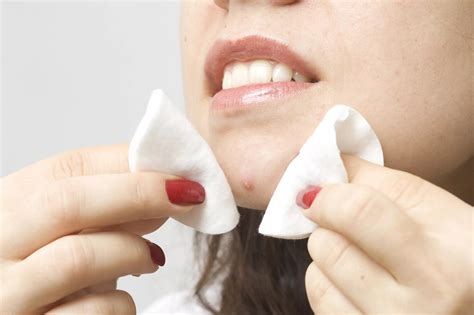 Tuyệt đối không nên nặn mụn quan điểm này đúng hay sai để nặn mụn an
