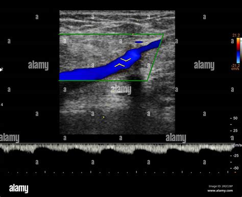 Détermination par échographie Doppler couleur chez les patients