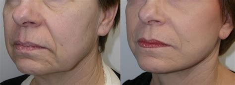 How To Prevent And Treat Saggy Skin As You Age Justinboey