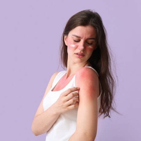 Alergia La Ambrozie Cauze Simptome Diagnostic I Metode De Tratament