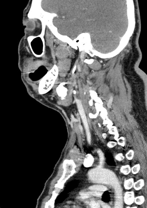 Left Submandibular Sialolithiasis Image Radiopaedia Org