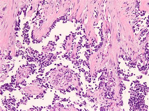 Pathology Outlines Alveolar Rhabdomyosarcoma