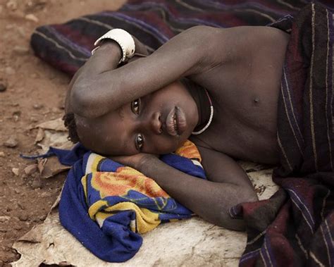 Malaria Patient Mursi Tribe Sth Ethiopia Rod Waddington Flickr