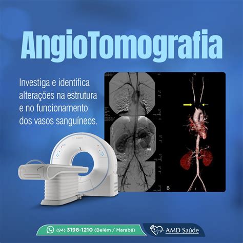 Angiotomografia O que é como funciona e o preparo AMD Saúde