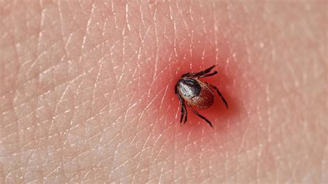 El Lyme desembarcó en Argentina qué es y cuáles son los síntomas