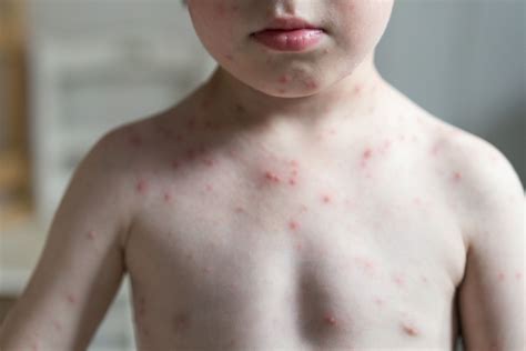 Shingles Vs Chickenpox
