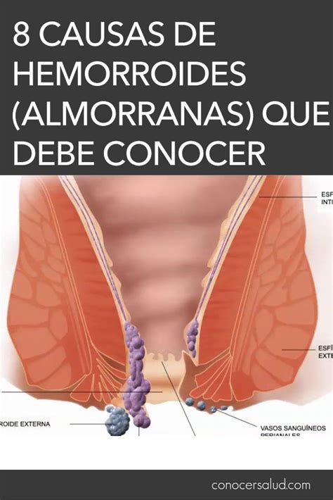 Causas De Hemorroides Almorranas Que Debe Conocer Salud Places