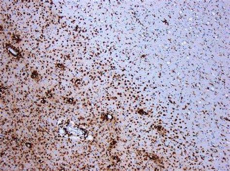 Un Farmaco Per L Acne Offre Nuovo Trattamento Per La Sclerosi Multipla