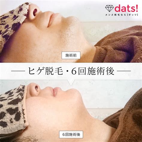 剃っても残る青髭の原因と対策メンズ脱毛店長 現役脱毛士 が解説します 男の全身脱毛dats ダッツヒゲ脱毛 VIO脱毛 東京