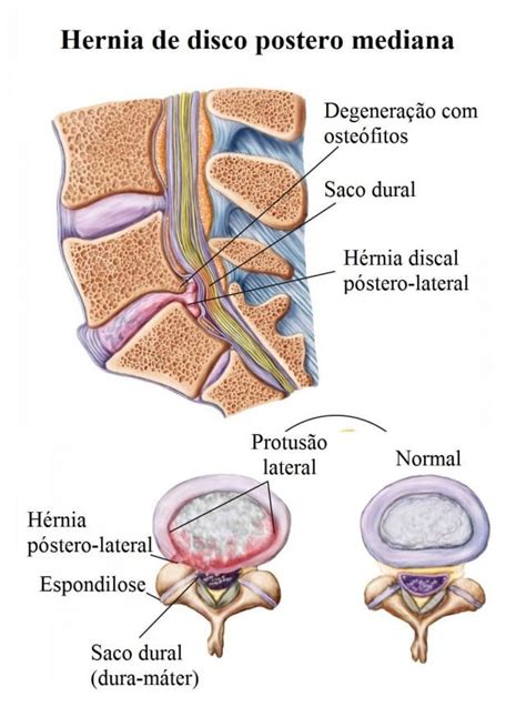 Hérnia de disco na coluna lombar expulsa central ou foraminal