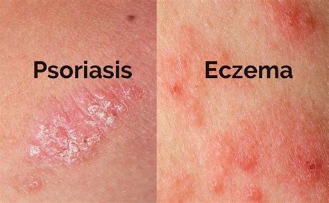 Whats The Difference Between Psoriasis And Eczema Eczema Association Of New Zealand Inc