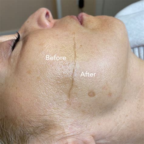 Dermaplaning 101 The Benefits Process Aftercare More Muse