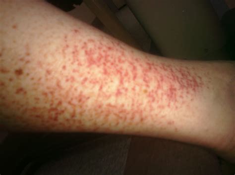 Petechiae Symphtoms Of Hemorhagic Spots HubPages