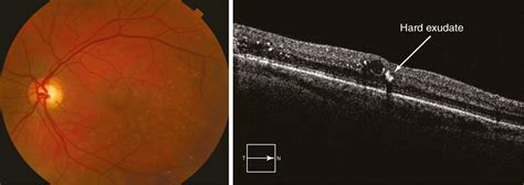 Nonproliferative Diabetic Retinopathy Clinical Tree