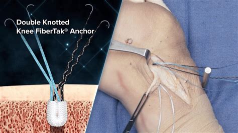 Double Knotted Knee FiberTak Anchor Product Demonstration YouTube