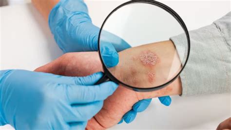 Understanding The Various Stages Of Hidradenitis Suppurativa Tumgazeteler