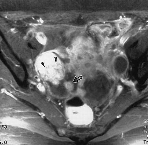 CT And MR Imaging Of Ovarian Tumors With Emphasis On Differential