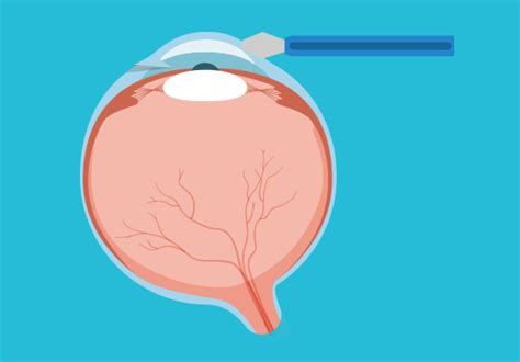 Chirurgie de la cataracte Les étapes de l opération