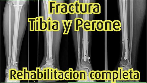 Fractura Tibia Y Perone Rehabilitacion Completa YouTube