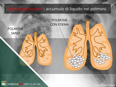 Edema Polmonare Acuto Cause Sintomi E Terapia