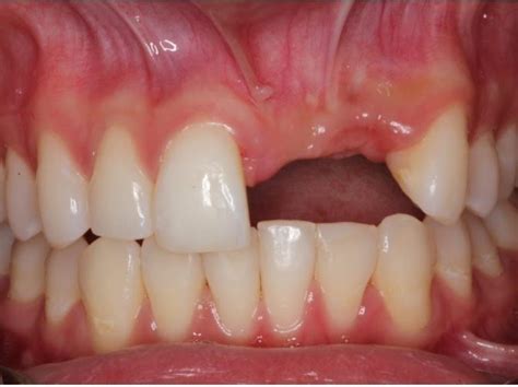 Horizontal And Vertical Ridge Augmentation Including Soft Tissue Grafts