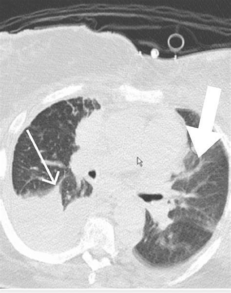 Computed Tomography Image Showing Left Loculated Pleural Effusion